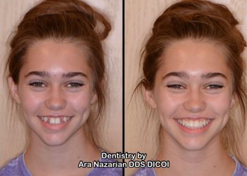 What are Maryland Bridges? | Dental Implant Dentist in Shelby Township, MI